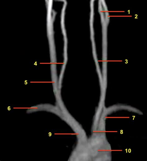 Dsa05 Great Artery Mr Angiogram Mra Diagram Quizlet