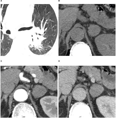 Adrenal Metastases In A 66 Year Old Man Pulmonary Window Of Primary Download Scientific