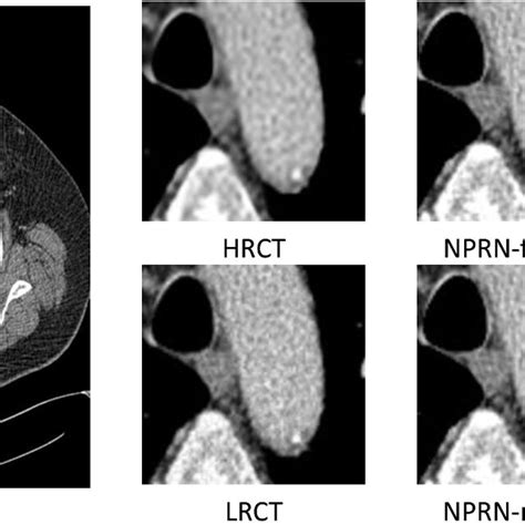 Visualization Comparisons On Mayo Public Dataset With 4 × Scale