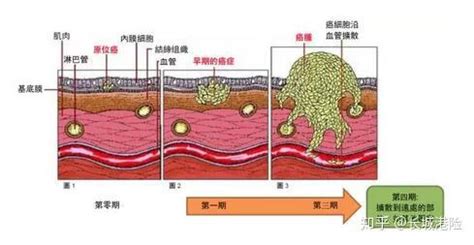癌症癌细胞的扩散和转移有什么不同 知乎