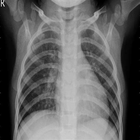 trpakov vit chest x ray classification at main