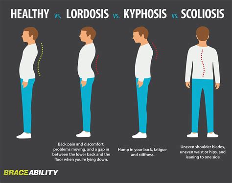 Lordosis Vs Kyphosis