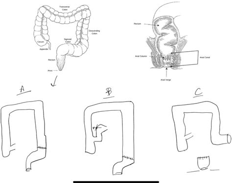 Improving Surgical Patient Education Materials Using Informational