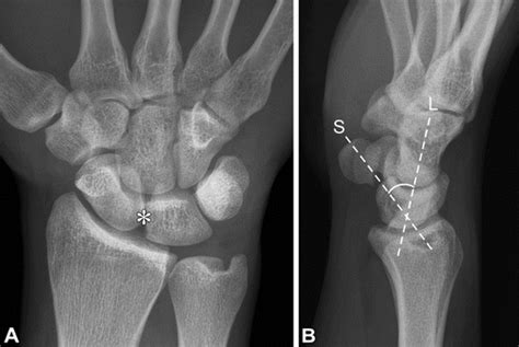 Scaphoid X Ray Angle