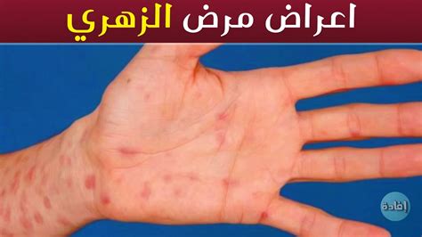 اعراض مرض الزهري Youtube