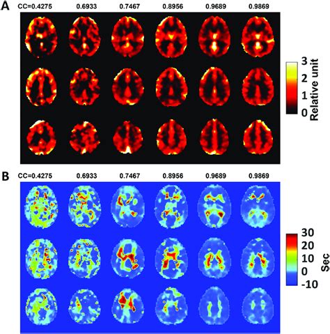 Examples Of Co2 Cvr Results A Relatiev Cvr Maps In Mni Space From