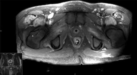 Magnetic Resonance Imaging Mri Pelvis Axial T1 Postgadolinium Images