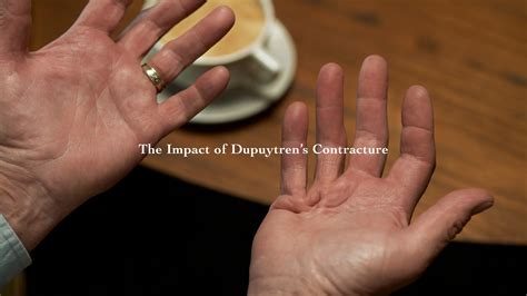Real Patient Testimonials About Xiaflex® For Dupuytrens Contracture
