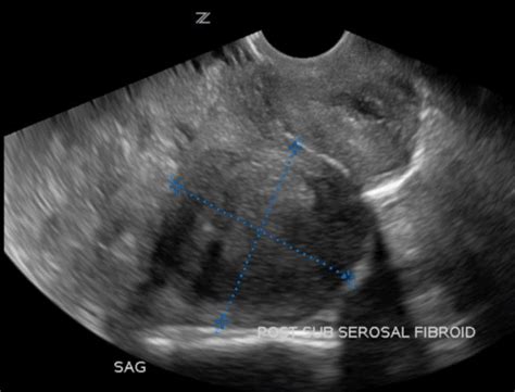Gynecology Pelvic Ultrasound Made Easy Step By Step Guide Artofit