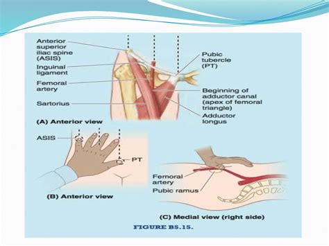 Femoral Artery Access For Catheterization Procedureure Pptx