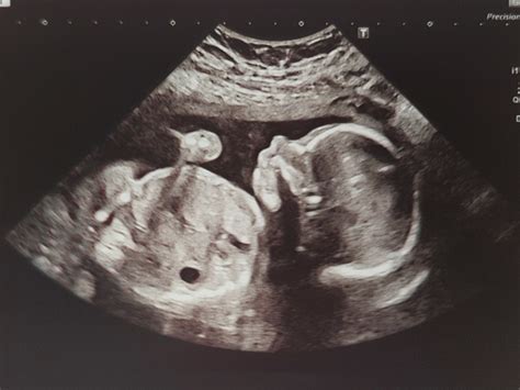 20 Week Scan Joy R Predaddit
