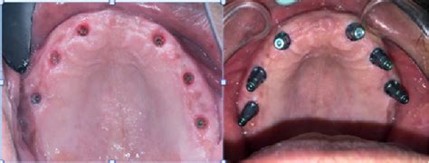 Implants Inserted According To The Planned Sites Download Scientific Diagram