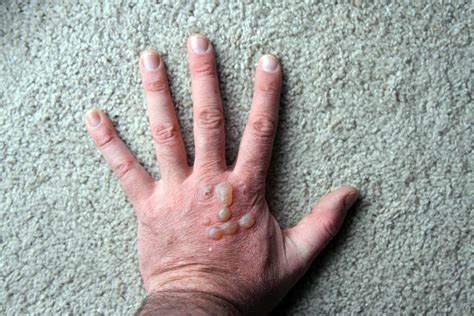 23 Types Of Skin Lesions And How To Treat Them