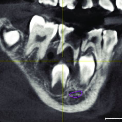 Pdf Bismuth Subnitrate Iodoform Parafin Paste Used In The Management Of Inflammatory
