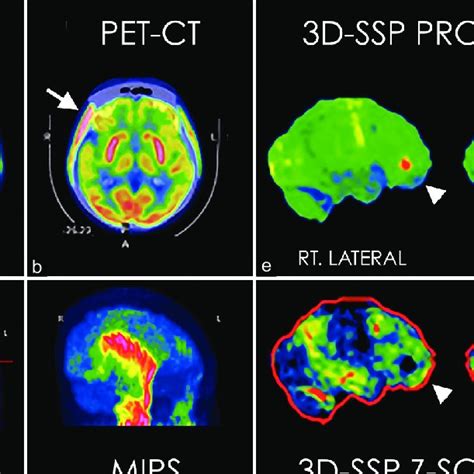 The Transaxial 18 F Fluorodeoxyglucose Brain Positron Emission Download Scientific Diagram