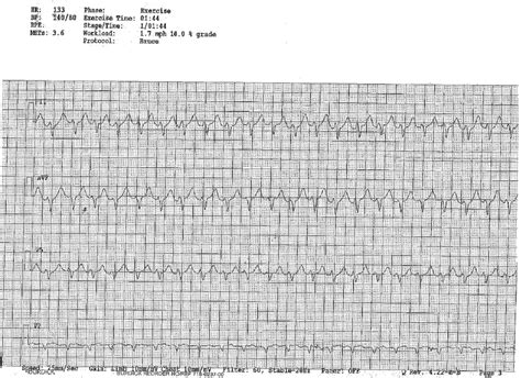 Exercise Induced Non Sustained Ventricular Tachycardia Wide Qrs