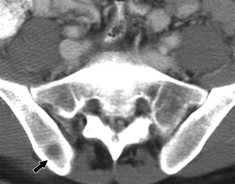 Imaging Manifestations Of Kaposi Sarcoma Radiographics