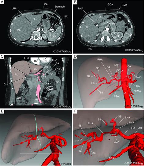 Hepatic Arterial Anatomy What Is The Hepatic Artery With Pictures