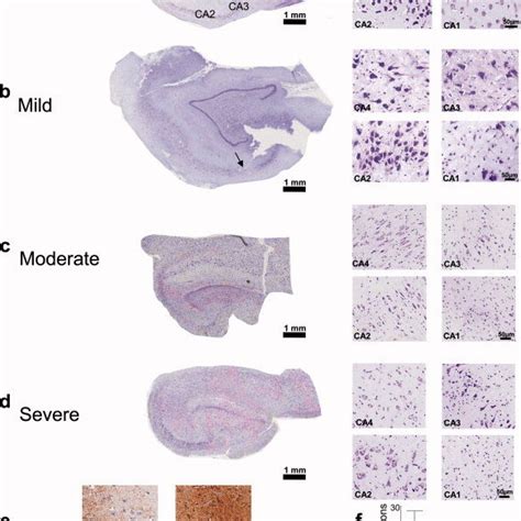 Histology From Human Hippocampal Surgical Specimens Ad Left Side