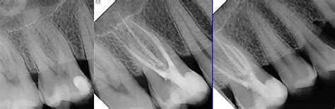 Кореново лечение на горен Д р Пламен Славов стоматолог