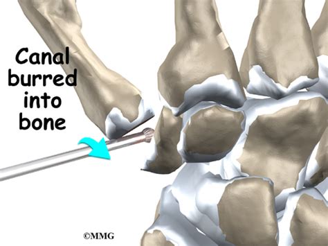 Artificial Joint Replacement Of The Thumb