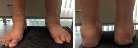 Custom Constrained 3d Total Talusnavicular Replacement Musculoskeletal Key