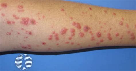 Figure 11 Blistering Image