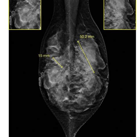 Mammogram At Initial Diagnosis Mlo Views Display Bi Rads C Breast Download Scientific Diagram