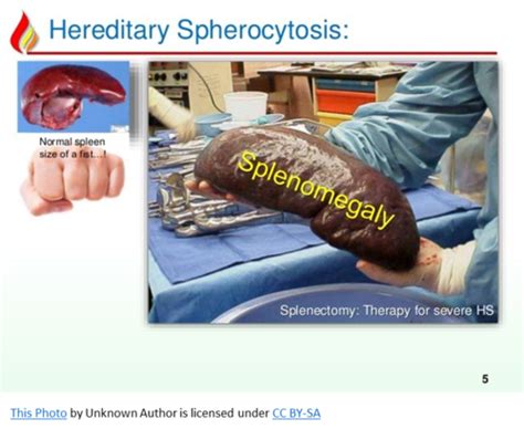8 Hemolytic Anemias Flashcards Quizlet