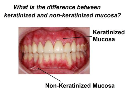 What Is The Difference Between Keratinized And Non Keratinized Mucosa News Dentagama