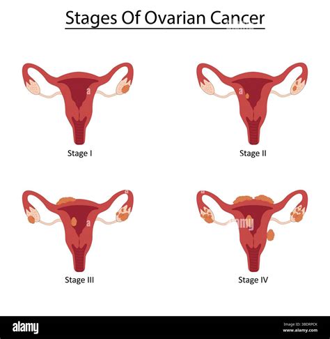 Stages Of Ovarian Cancer Vector Illustration Stock Vector Image And Art