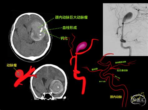头颅 Ct 经典高密度征象汇总 脑医汇