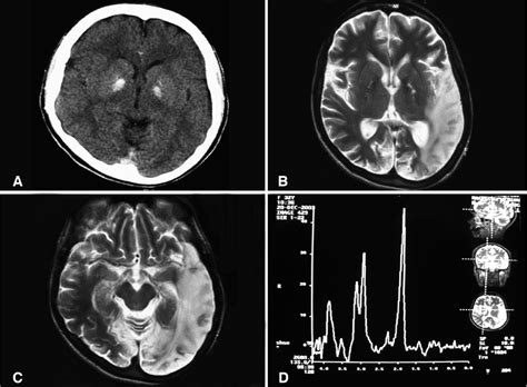 File A Computed Tomography Brain Scan Showing Bilateral Basal Ganglia