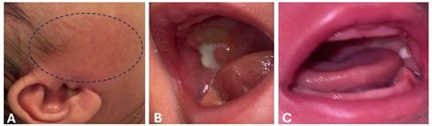 Bilateral Neonatal Suppurative Parotitis A Case Report And Review Of