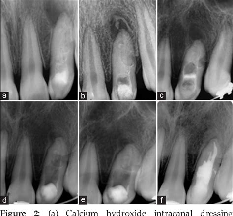 Figure 2 From Dens In Dente A Minimally Invasive Nonsurgical Approach