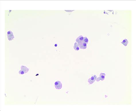 The Picture Shows A Lbc Slide Of A Thyroid Nodule Composed Of Download Scientific Diagram