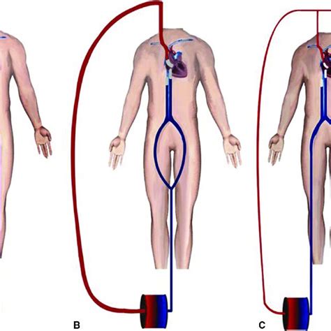 Different Configurations Of Venovenous Ecmo Vv Ecmo Circuit A Download Scientific Diagram