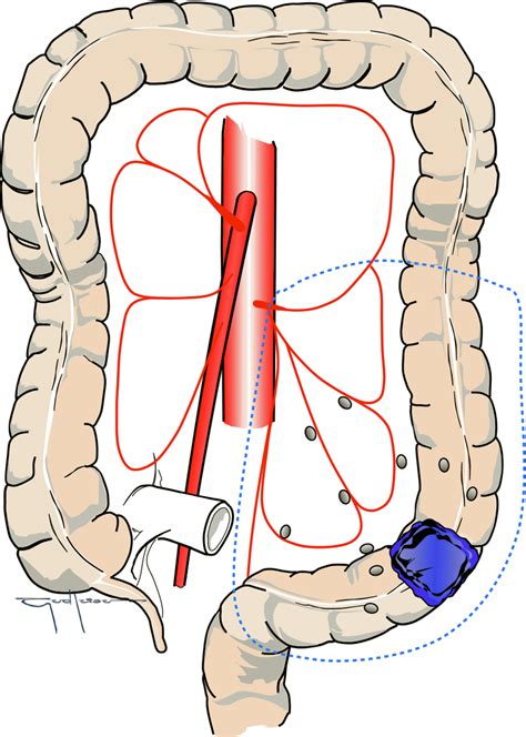 Sigmoid Resection From Weber K Perrakis A Hohenberger W Standard Download Scientific