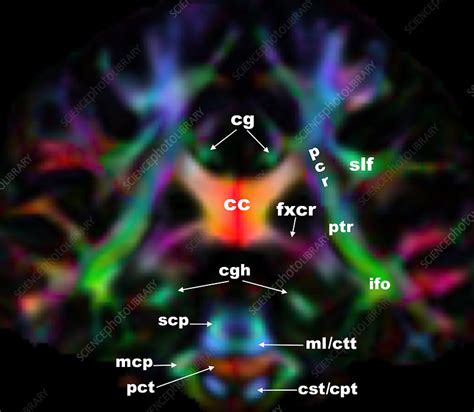 White Matter Brain Tracts Dti Stock Image C036 6027 Science Photo Library