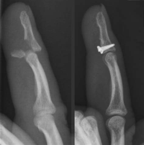 Hand Fracture Raleigh Hand Surgery — Joseph J Schreiber Md