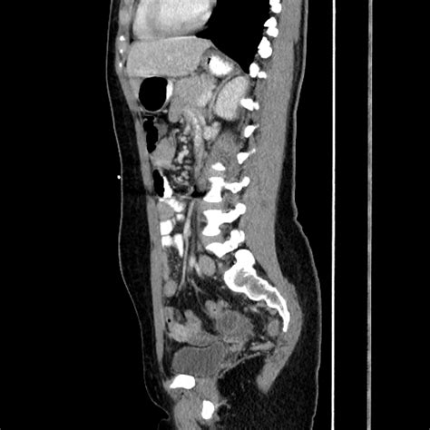 Filecrohns Disease Terminal Ileitis Fistulizing Radiopaedia 98245