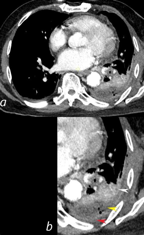 Faces Of Parapneumonic Effusion Lungs
