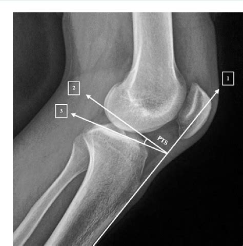 Figure 1 From Anatomic Variation Of Posterior Slope Of Tibial Plateau In Adults Semantic Scholar