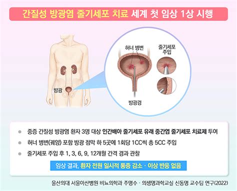 간질성 방광염 줄기세포 치료 세계 첫 임상 1상 시행 의료 뉴스 서울아산병원 뉴스룸