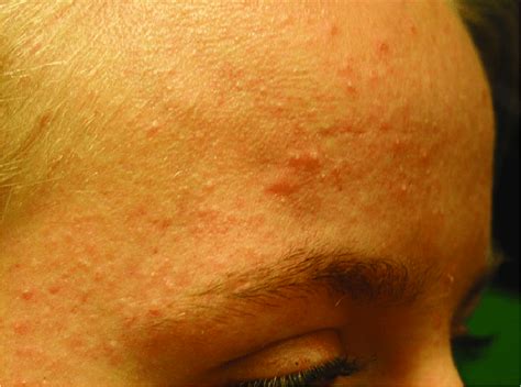 One And A Half Years After Surgery Beginning Of Hemifacial Atrophy On