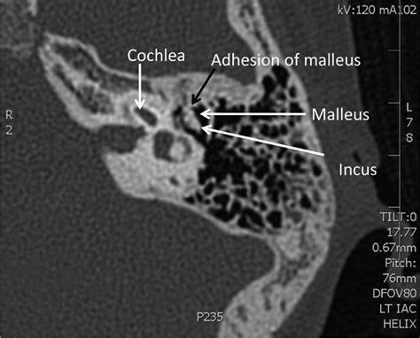 Scutum Temporal Bone