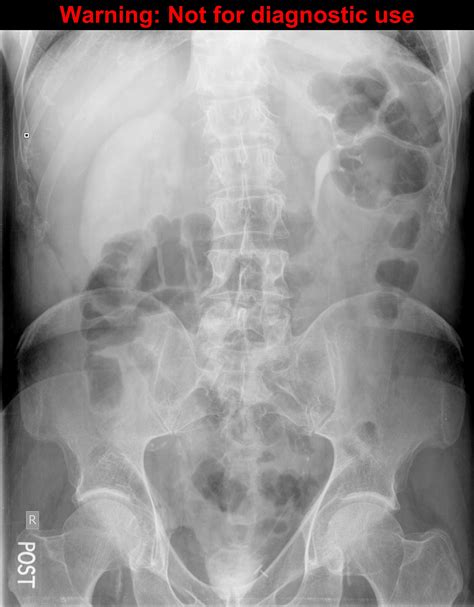 Delayed Nephrogram Ivp Image