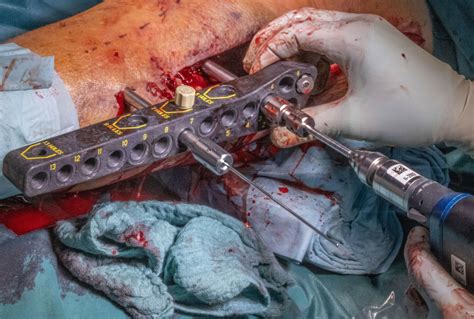 Tibial Fracture Fixation Peri Prosthetic Fracture Fixed With Zimmer