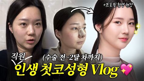 코성형 브이로그 성형외과 직원이 직접 받은 코수술 리얼후기경과사진 전후 비교 마무리 제3탄 Youtube