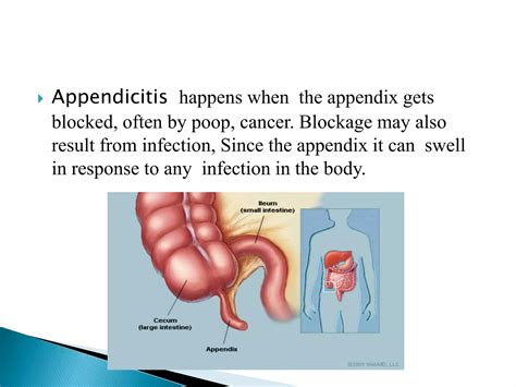 Appendicitis Ppt